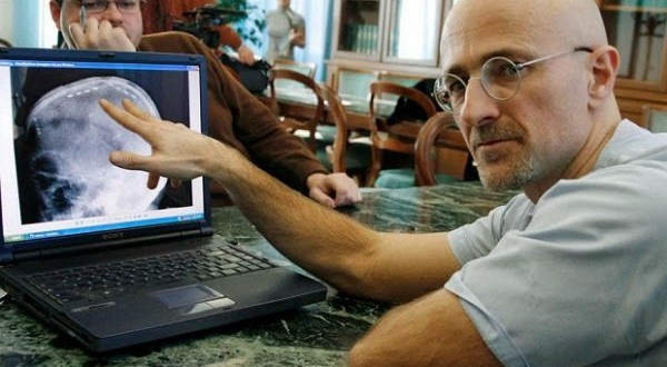 World's First Head Transplant Successful | Pnoys.com